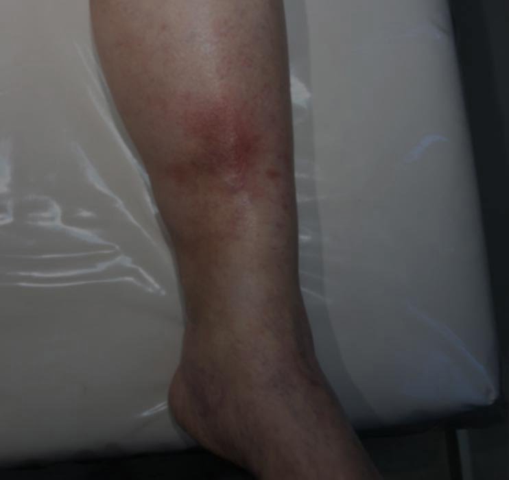 Flebitis Del Pie Flebitis Care Guide Information En Espanol